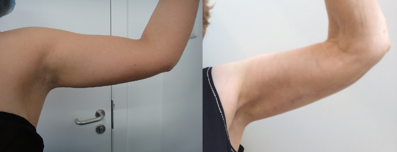 How To Lose Arm Fat: JAP Spot Reduction Tennis Study, Upper Arm ...
