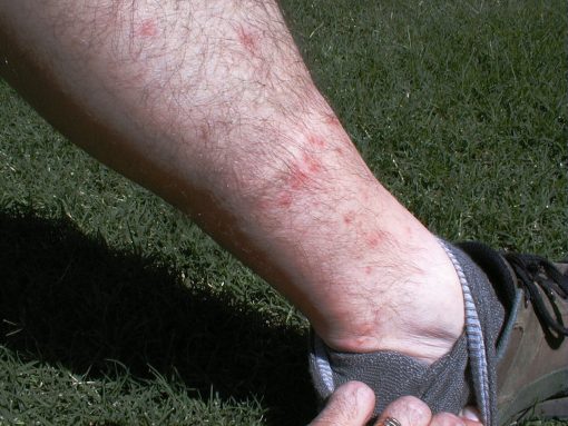 Chigger Bites: Symptoms, Treatment, And Prevention Tips 2025