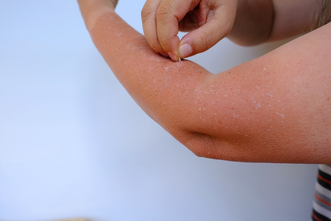Sun Poisoning: Warning Signs, Risks, And Tips (2025 Guide)